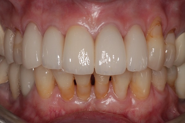 Dental Implant Before & Afters Fort Myers FL, Taschner Periodontics
